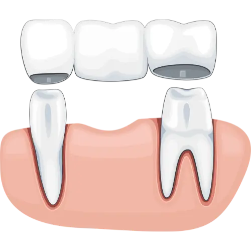 Dental Bridges – Goldstream Dental Clinic